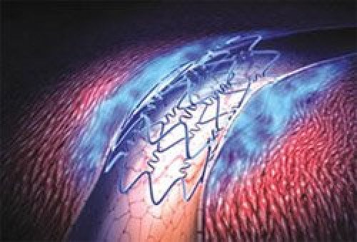 Stent | Vascular One